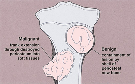 Benign Bone Growths